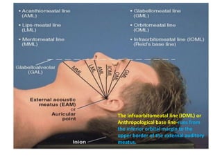 Radiological anatomy of the Head and Neck | PDF