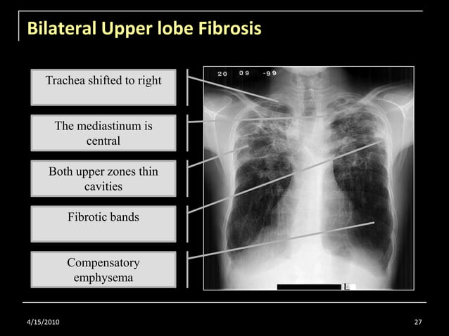 Radiology for Undergraduate Part 1 | PPTX | Lung and Respiratory Health ...