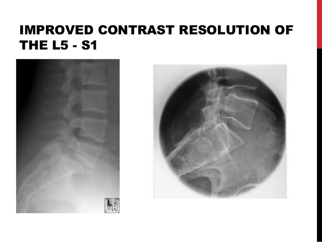 Rad 206 p11 Fundamentals of Imaging - Control of Scatter Radiation
