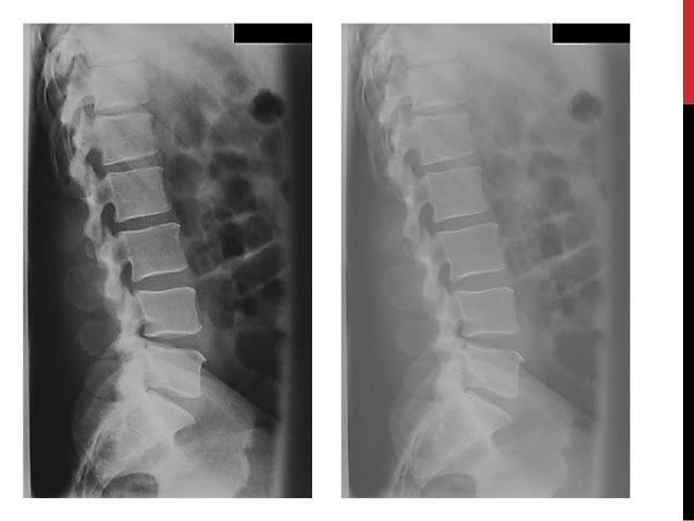 Rad 206 p11 Fundamentals of Imaging - Control of Scatter Radiation