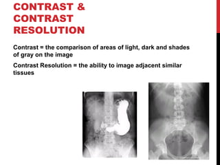 Rad 206 p12 Fundamentals of Imaging - Control of Scatter Radiation | PPT