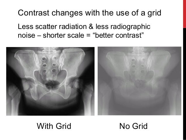 Rad 206 p12 Fundamentals of Imaging - Control of Scatter Radiation