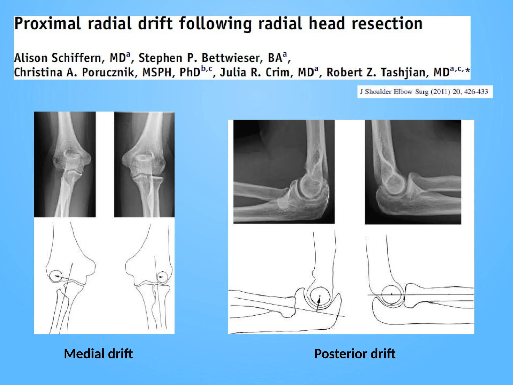 radial-head-fractures-treatment-lecture.pptx