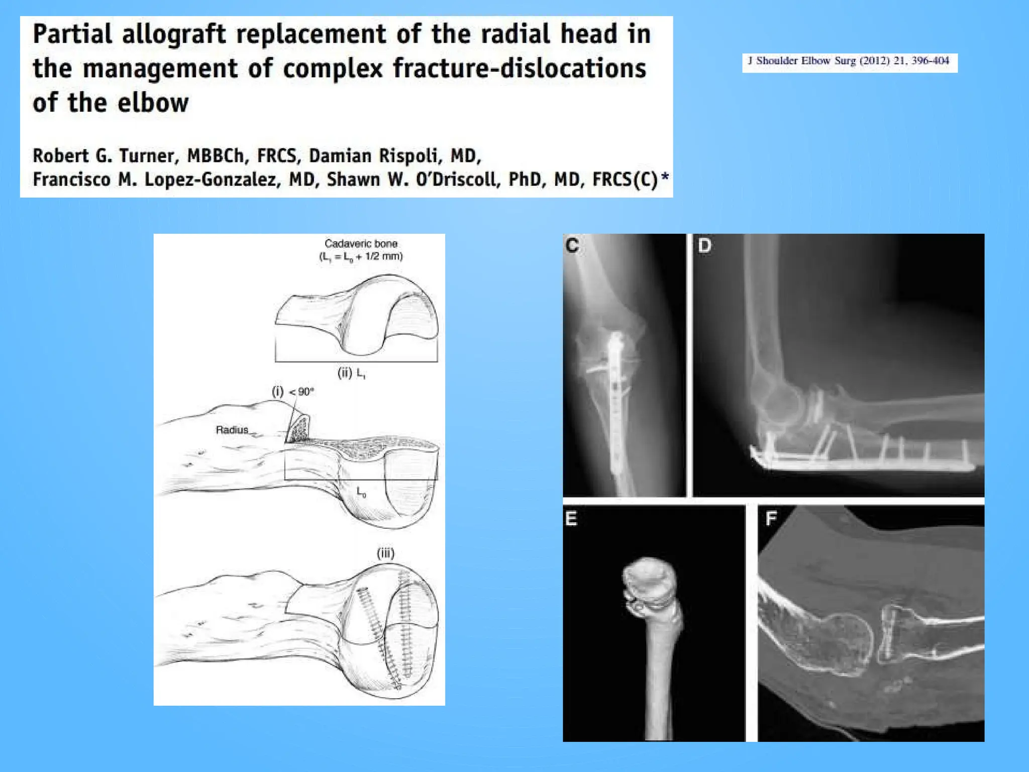 radial-head-fractures-treatment-lecture.pptx