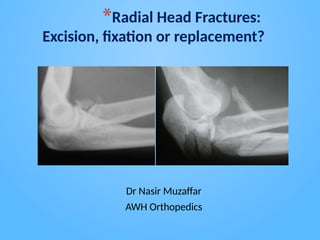 radial-head-fractures-treatment-lecture.pptx