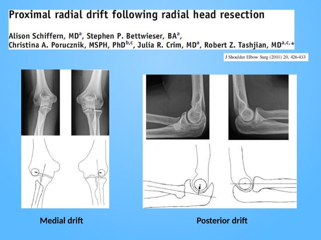 radial-head-fractures-treatment-lecture.pptx | Death, Injury, or ...