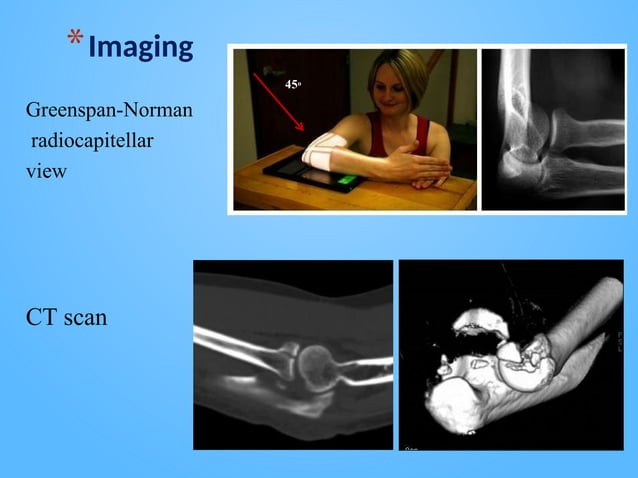 radial-head-fractures-treatment-lecture.pptx | Death, Injury, or ...