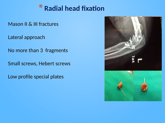 radial-head-fractures-treatment-lecture.pptx | Death, Injury, or ...
