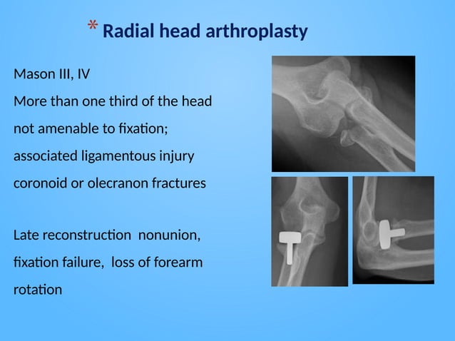 radial-head-fractures-treatment-lecture.pptx | Death, Injury, or ...