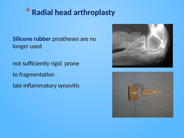 radial-head-fractures-treatment-lecture.pptx | Death, Injury, or ...