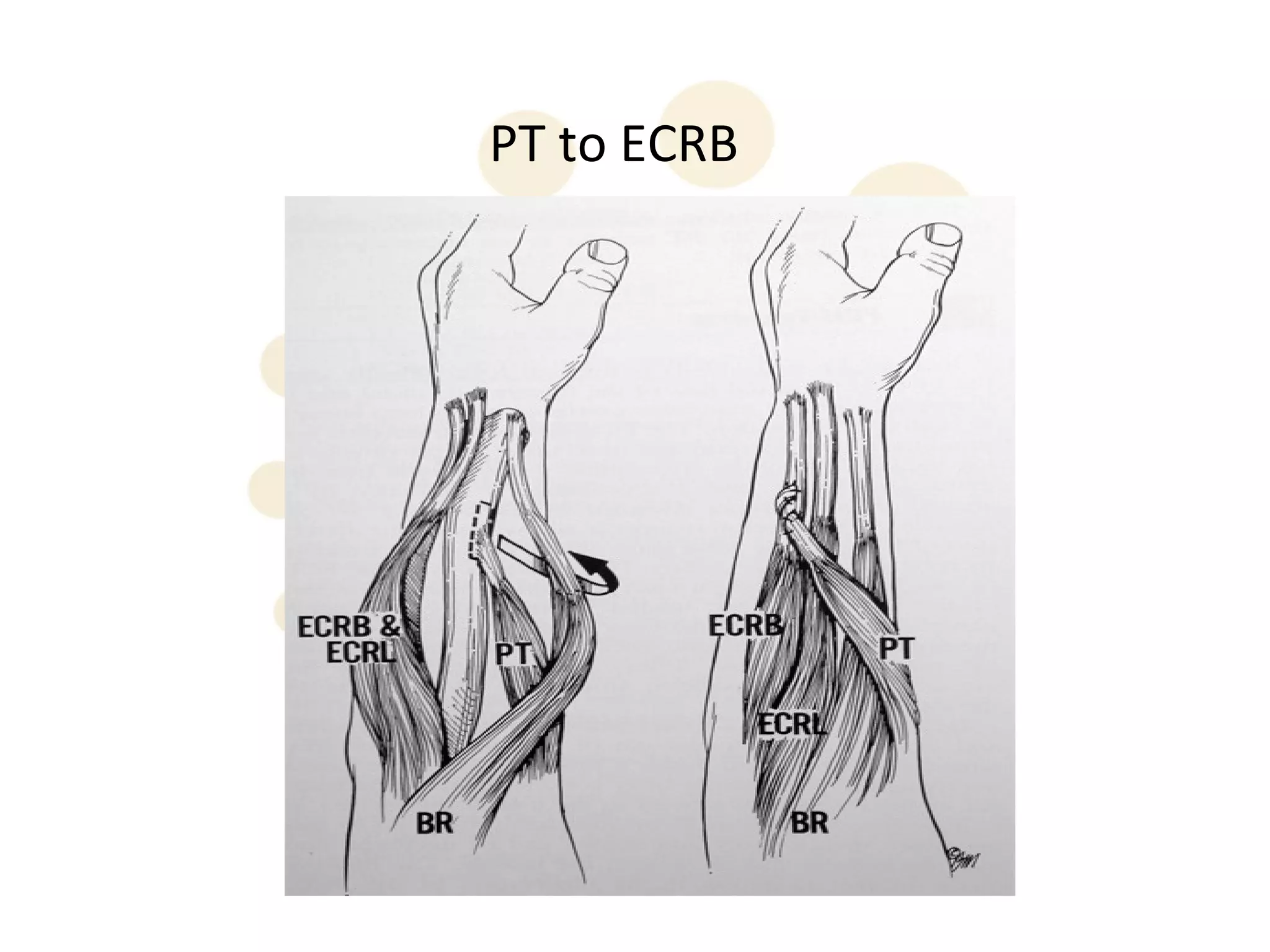 Radial nerve-palsy-tendon-transfers | PPT