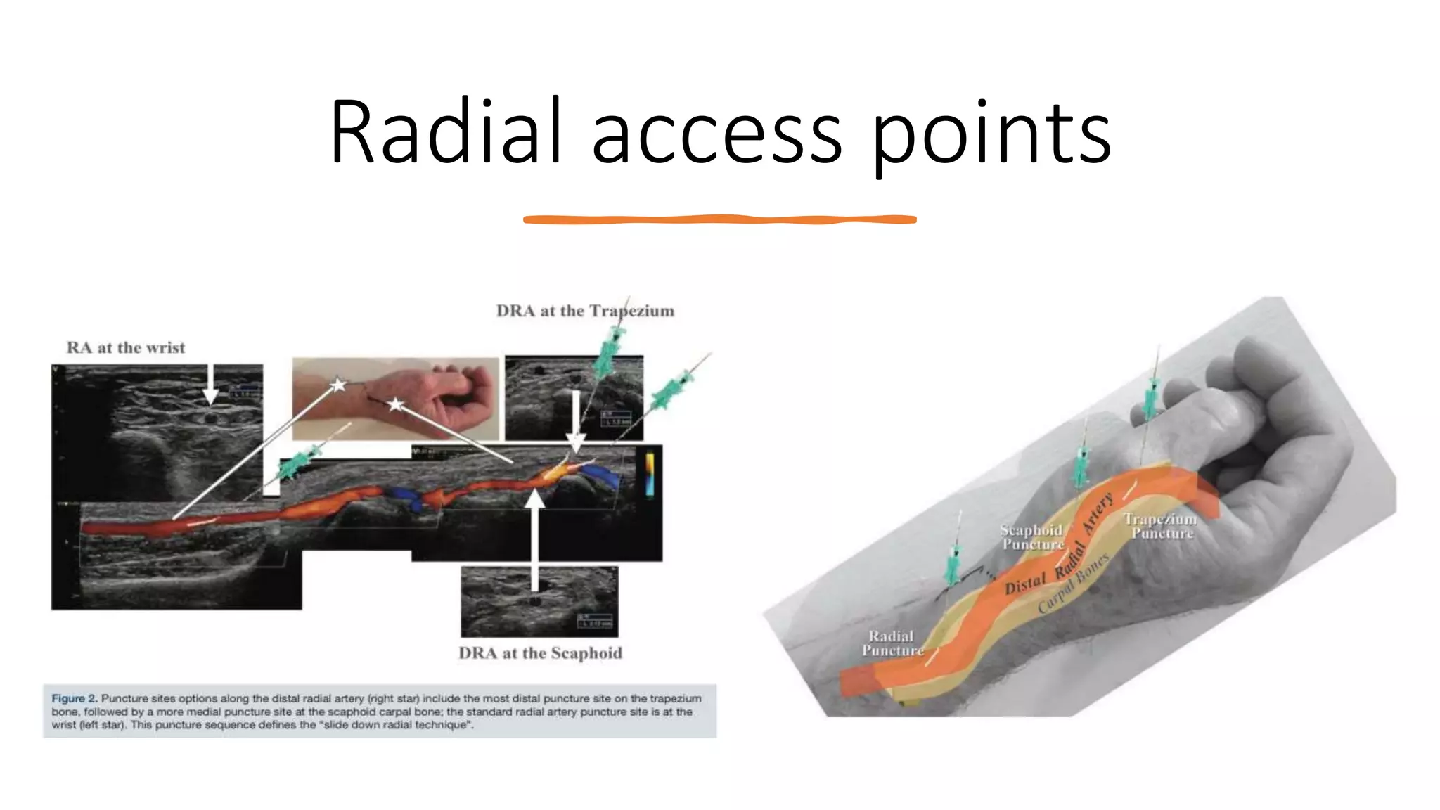 Radial Access ISVIR.pptx
