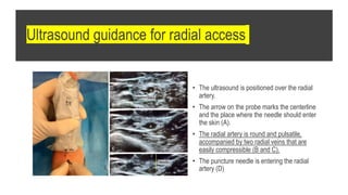 Radial artery access ,complications and magement | PPTX