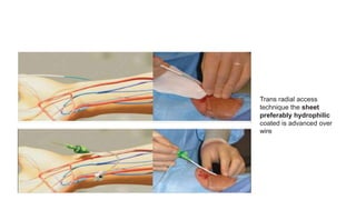 Radial artery access ,complications and magement | PPTX