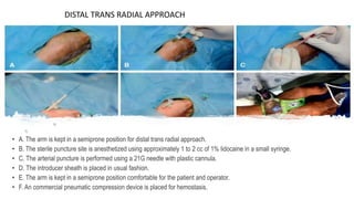 Radial artery access ,complications and magement | PPTX