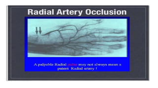 Radial artery access ,complications and magement | PPTX