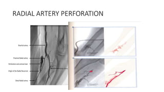 Radial artery access ,complications and magement | PPTX