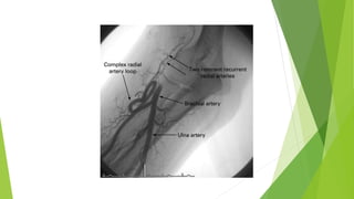 Radial artery access[1] | PPTX