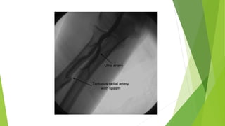 Radial artery access[1] | PPTX