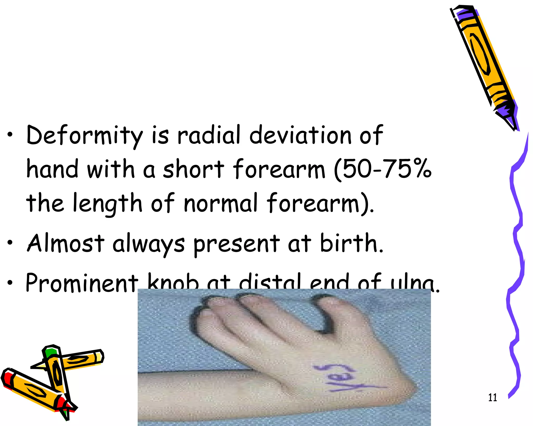 Radial club hand | PPT