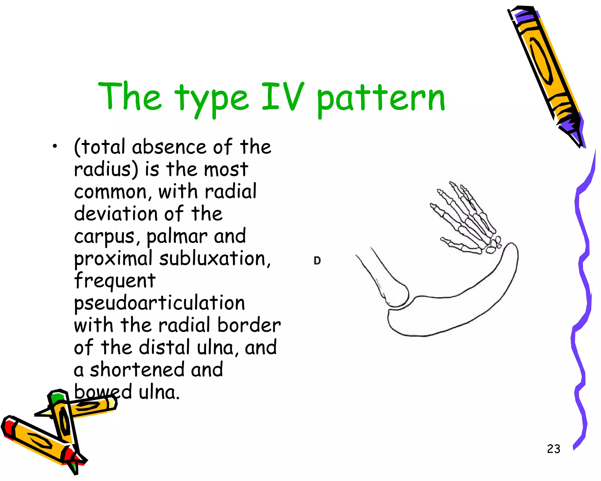 Radial club hand | PPT