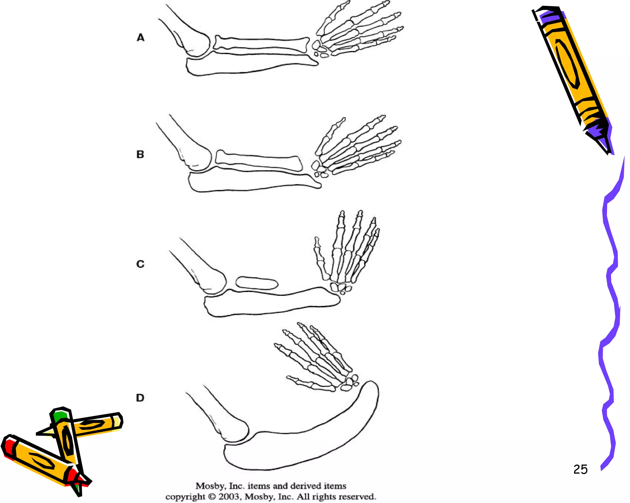 Radial club hand | PPT