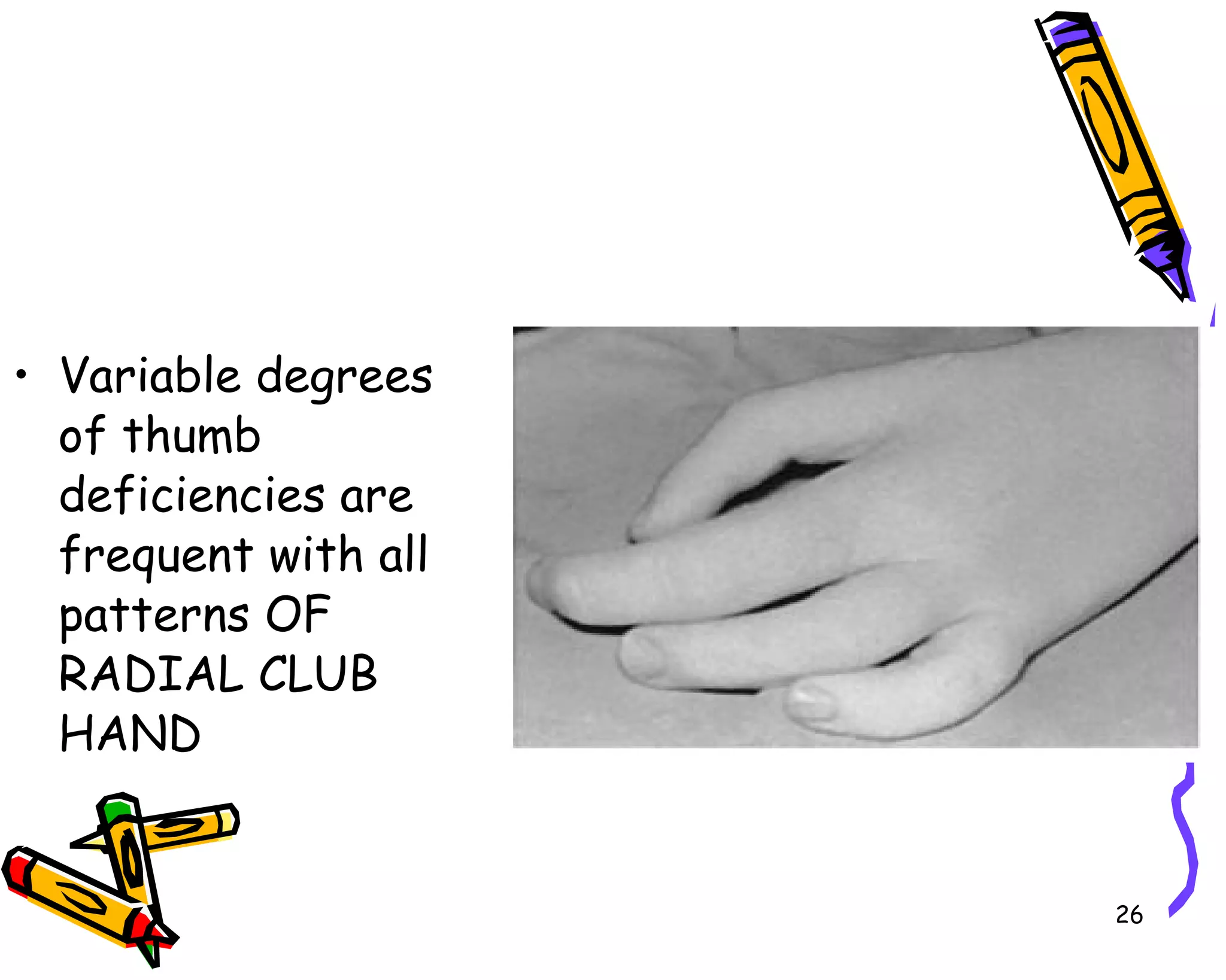 Radial club hand | PPT