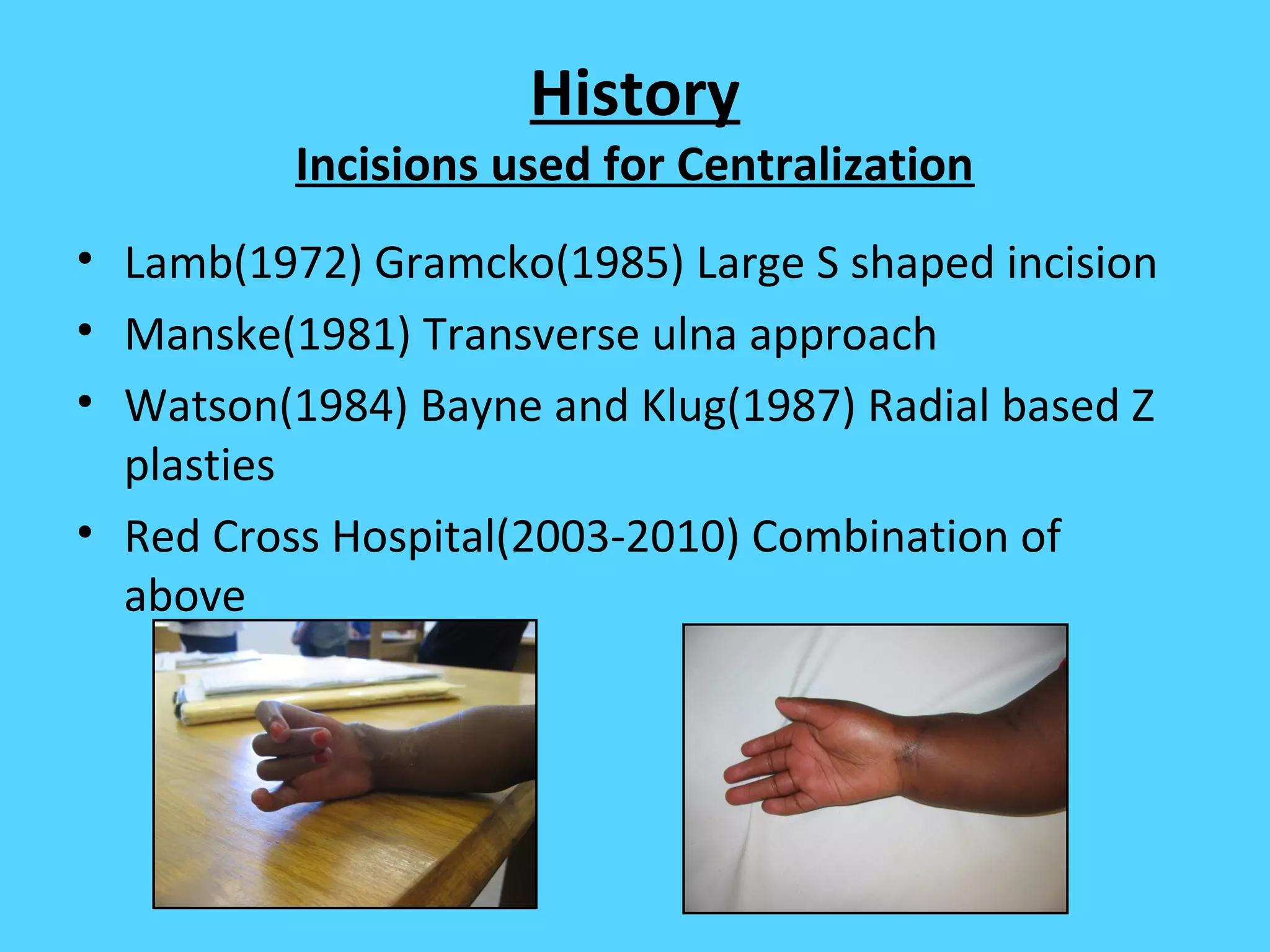 Radial Club Hand | PPT