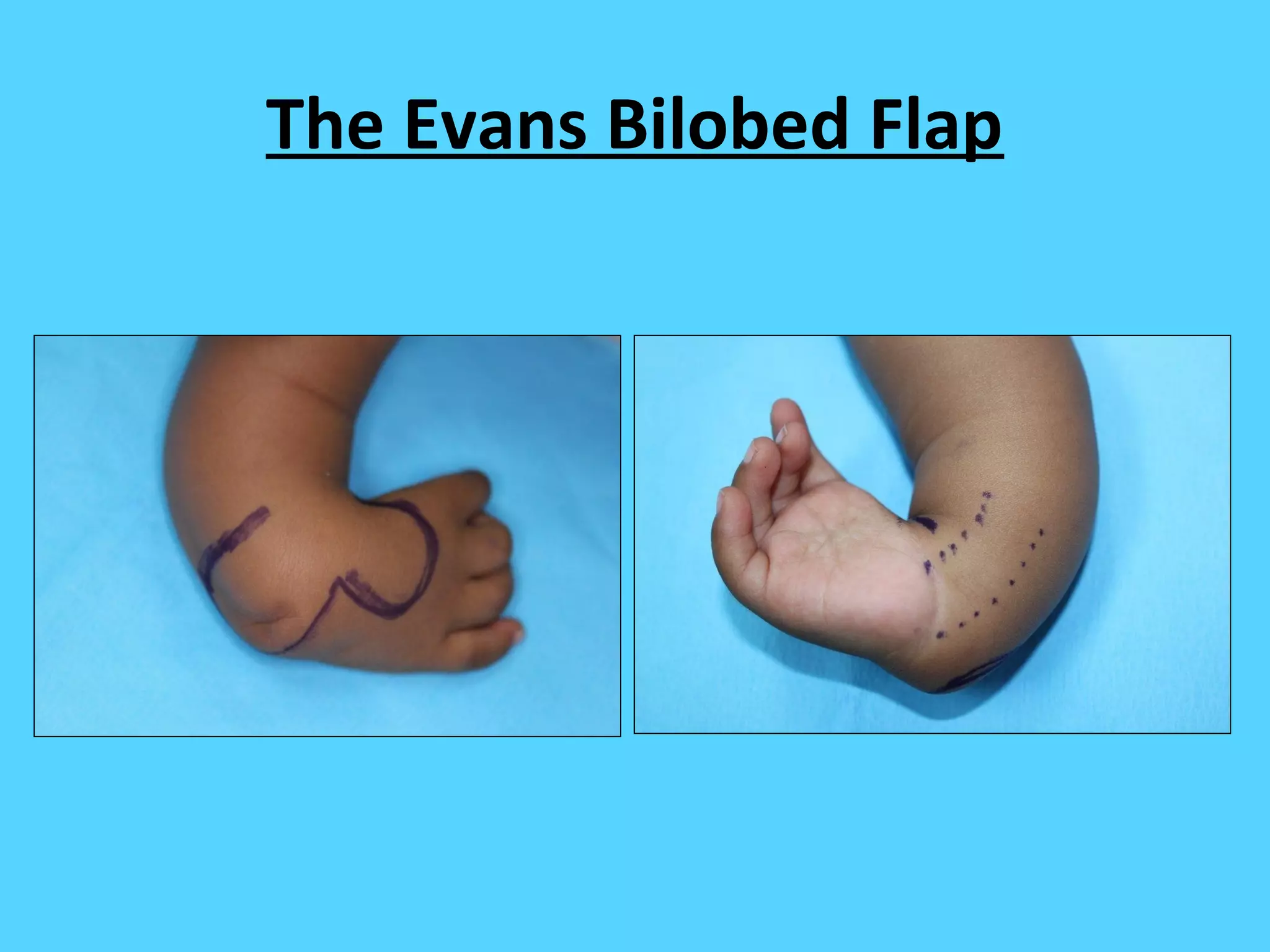 Radial Club Hand | PPT