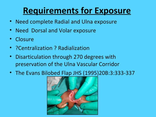 Radial Club Hand | PPT