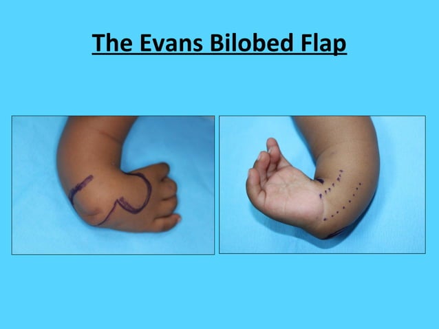 Radial Club Hand | PPT