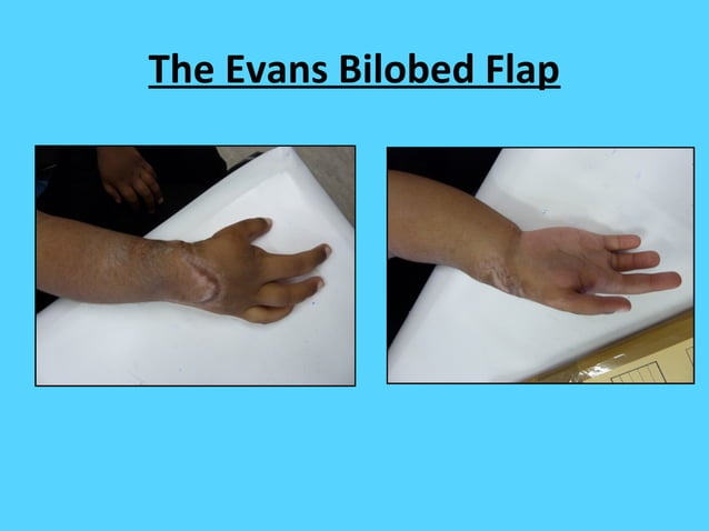 Radial Club Hand | PPT