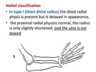 Radial club hand | PPTX