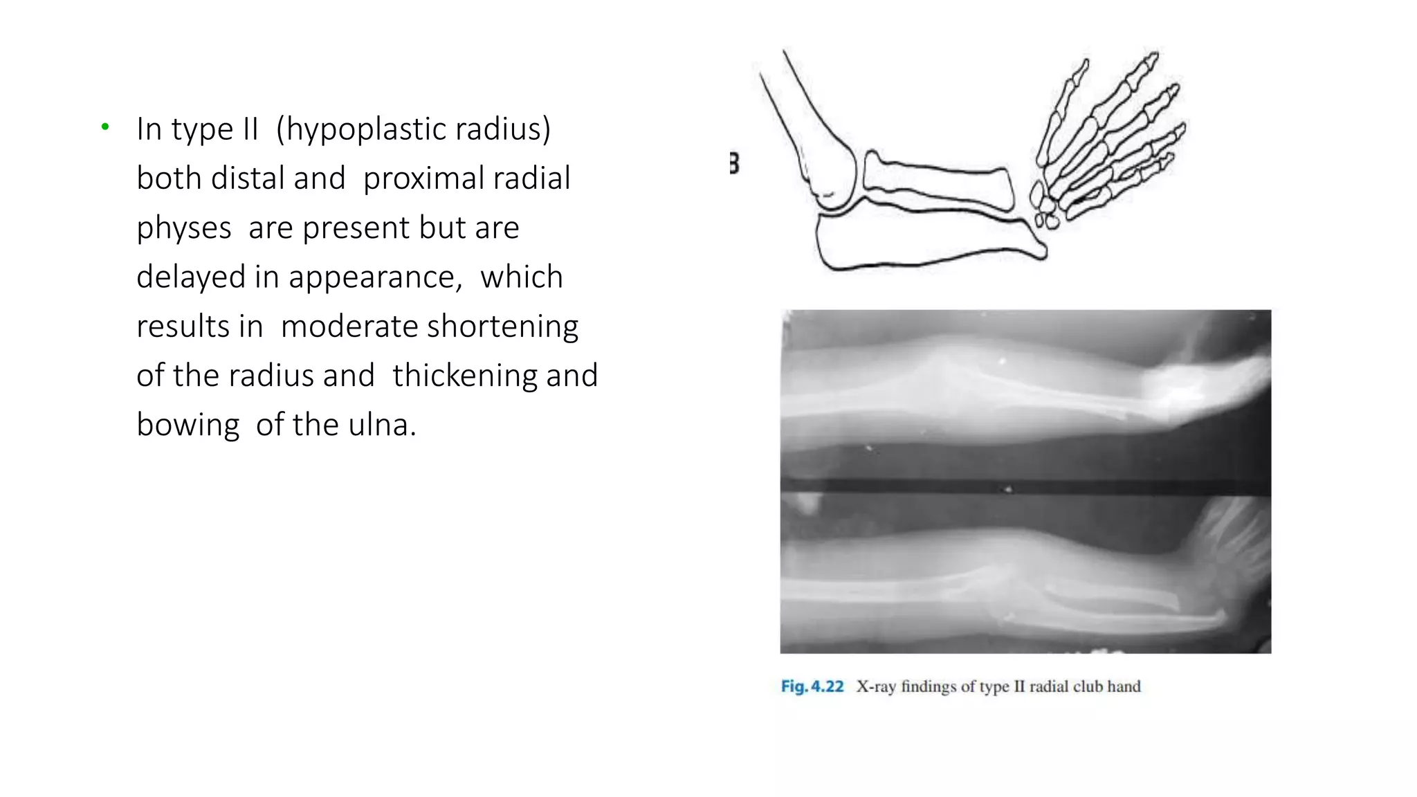 Radial club hand (Radial Dysplasia) | PPTX