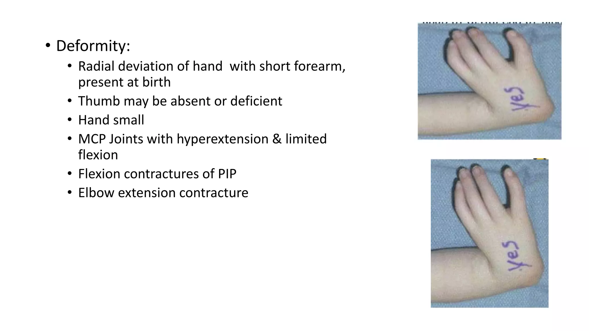 Radial club hand (Radial Dysplasia) | PPTX
