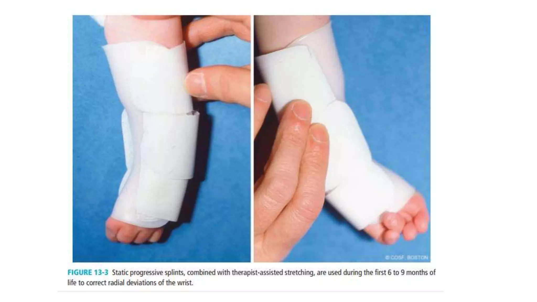Radial club hand (Radial Dysplasia) | PPTX