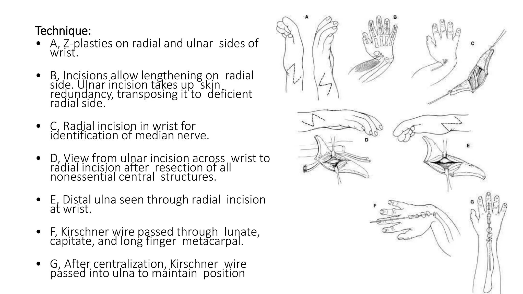 Radial club hand (Radial Dysplasia) | PPTX