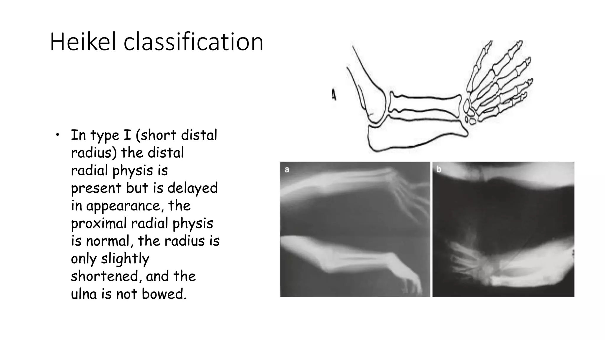 Radial club hand (Radial Dysplasia) | PPTX