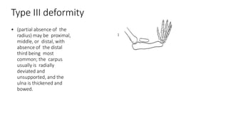 Radial club hand (Radial Dysplasia) | PPTX
