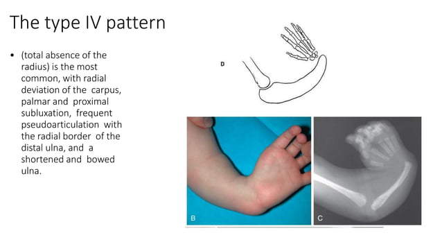 Radial club hand (Radial Dysplasia) | PPTX | Death, Injury, or Military ...