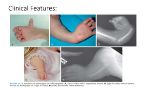 Radial club hand (Radial Dysplasia) | PPTX
