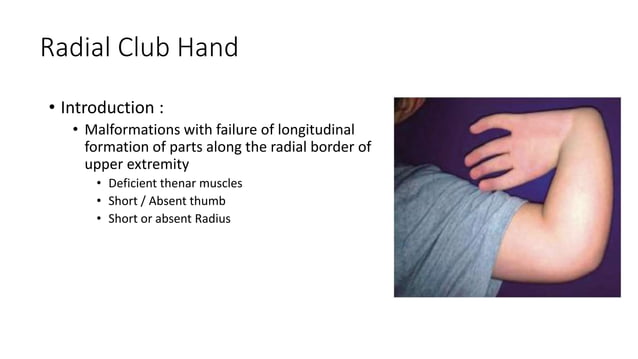 Radial club hand (Radial Dysplasia) | PPTX | Death, Injury, or Military ...