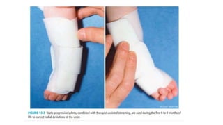 Radial club hand (Radial Dysplasia) | PPTX
