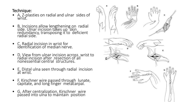 Radial club hand (Radial Dysplasia) | PPTX | Death, Injury, or Military ...
