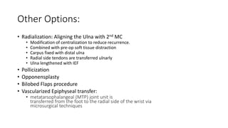 Radial club hand (Radial Dysplasia) | PPTX