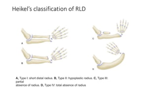 Radial club hand (Radial Dysplasia) | PPTX