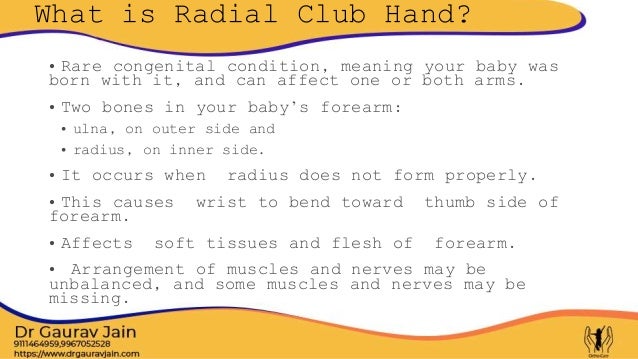 Radial club hand : Rare but treatable condition | PPTX