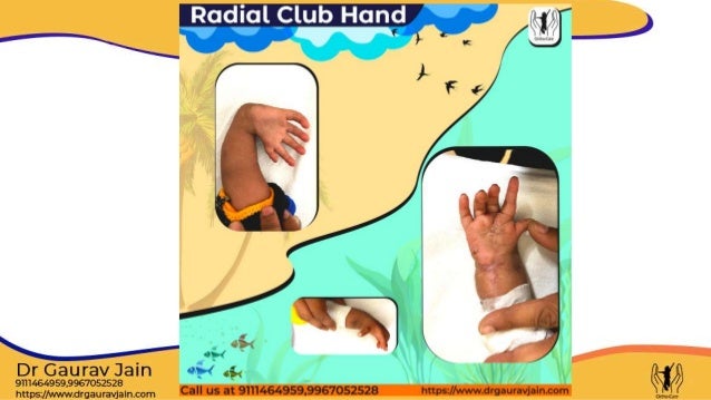 Radial club hand : Rare but treatable condition | PPTX