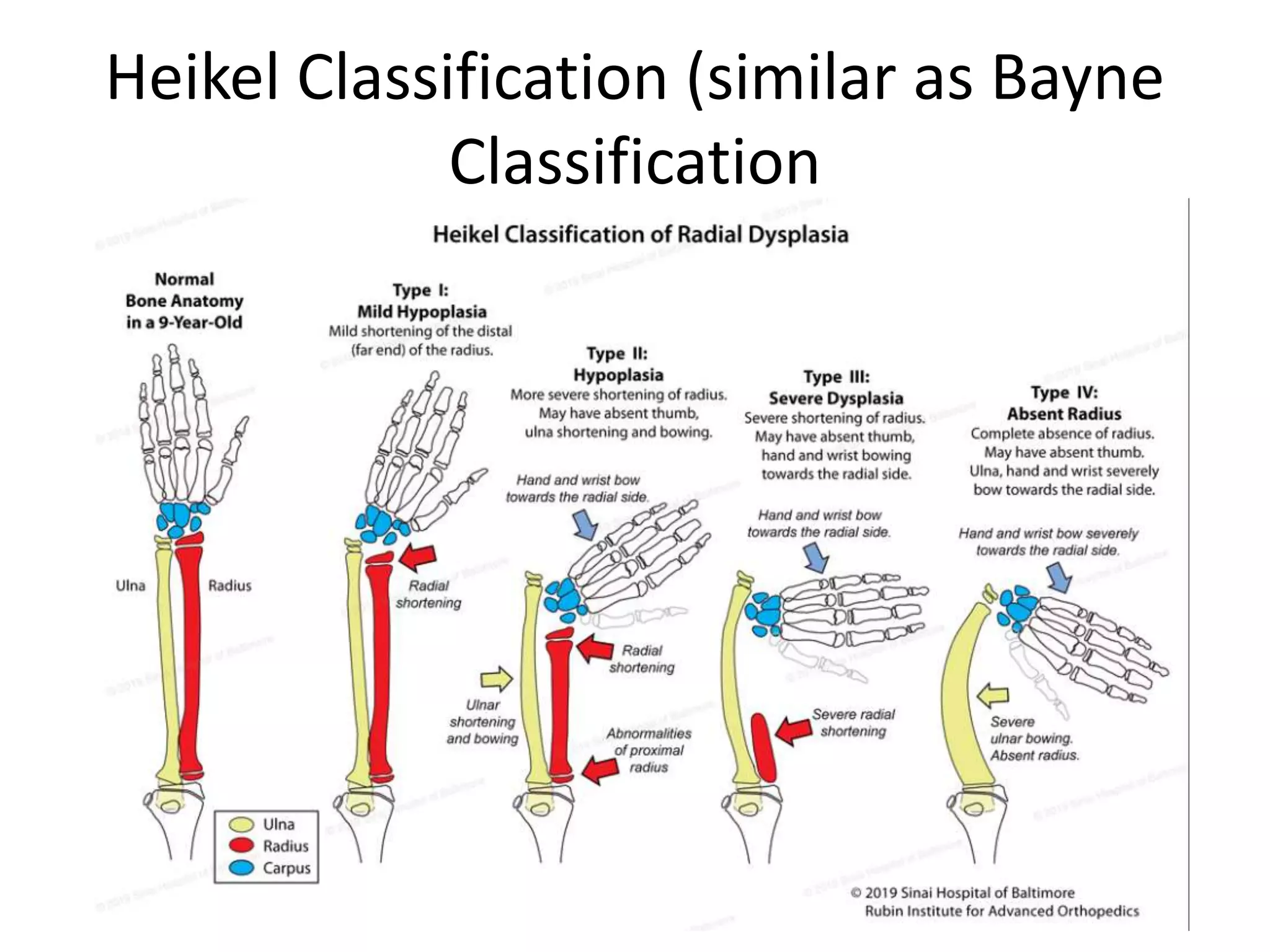 Radial Deficiency and Management.pptx