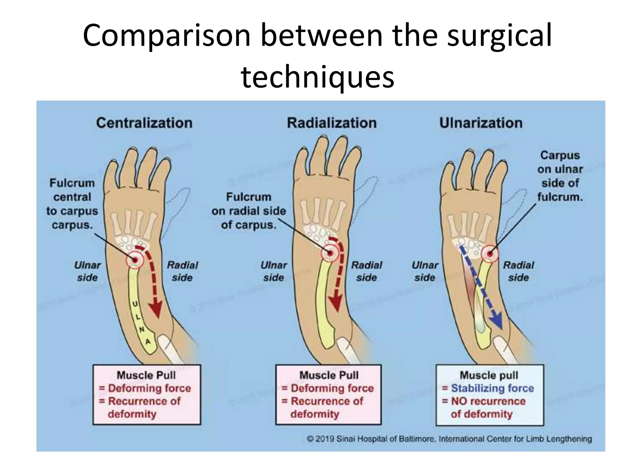 Radial Deficiency and Management.pptx